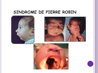 Enfermedades raras: Síndrome de Pierre Robin