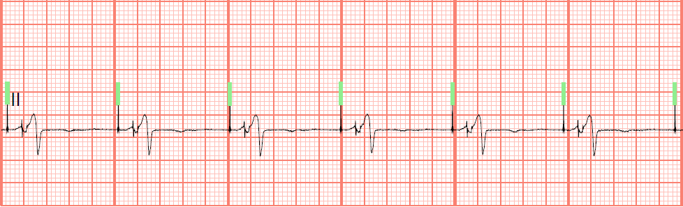 EKG Quiz 359