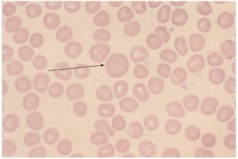 FICHERO HEMATOLOGIA : Macrocitos