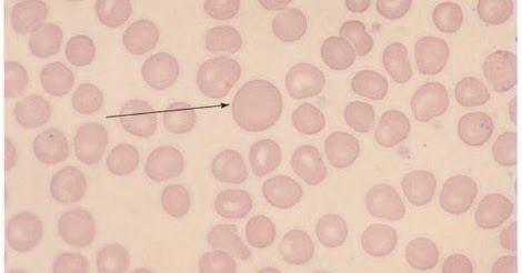 FICHERO HEMATOLOGIA : Macrocitos
