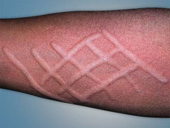 Dr. Modi's Homoeopathic Clinic: urticaria