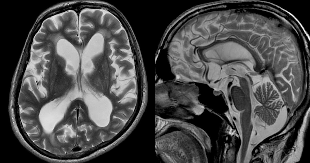 Dr Balaji Anvekar FRCR: Role of MR Csf flow study in NPH