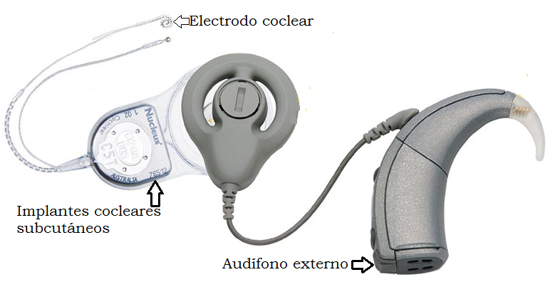 El Baúl Radiológico: IMPLANTES COCLEARES: SEGURIDAD EN RESONANCIA ...