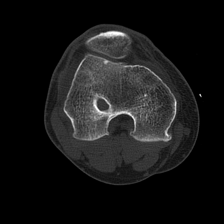 CT Knee - Radiology Imaging