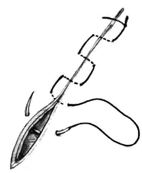 [GUIA] TIPOS DE SUTURAS