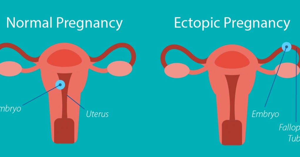 Senang Hamil: Tanda-Tanda Mengalami Kehamilan Luar Rahim (Ectopic ...