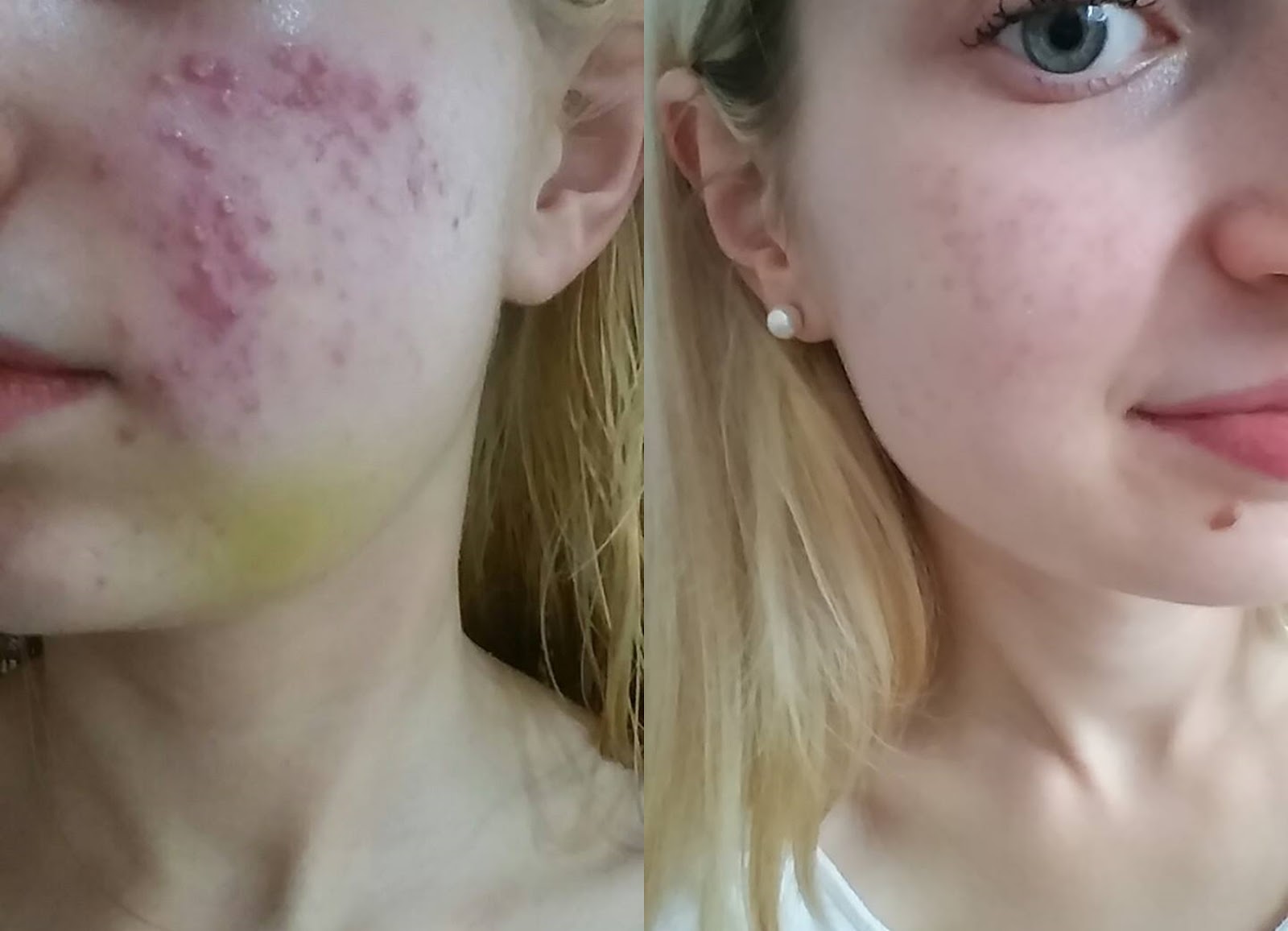 Izotek efekty działania. Jakie efekty daje Izotek? Skutki uboczne ...