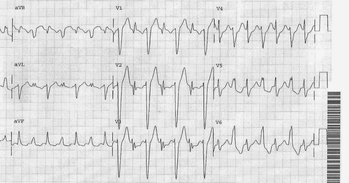 Dr. Smith's ECG Blog: A Southeast Asian with Tachycardia and ...