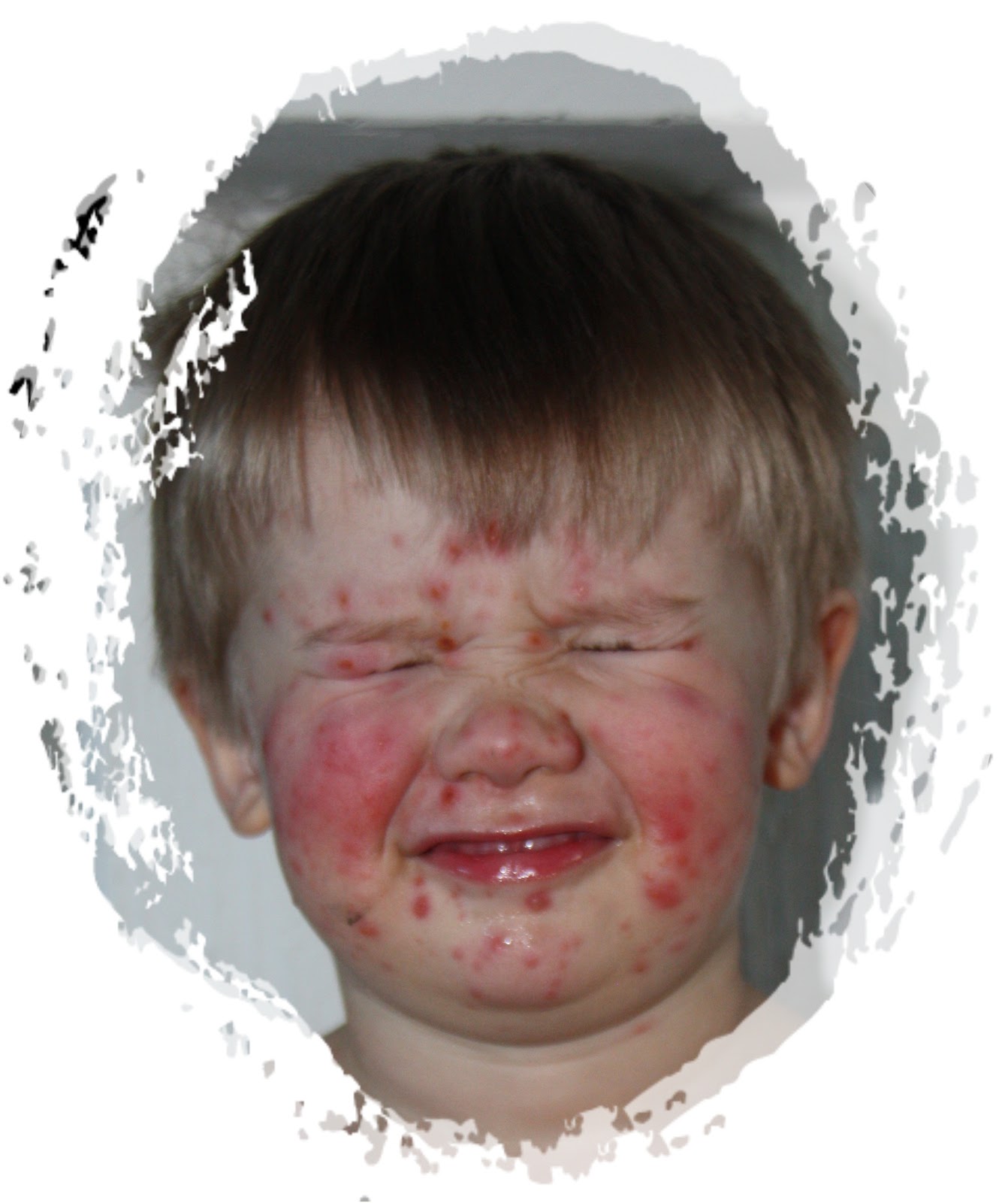 Hopeasydän: Vesirokko