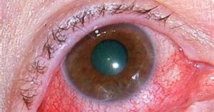 red eye disease drakengard Common causes of red eye - Diseases Club ...