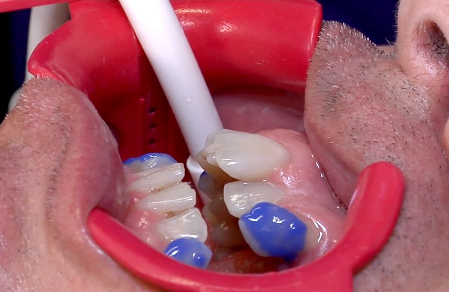ORTHODONTICS: Invisalign step by step (Video 1)