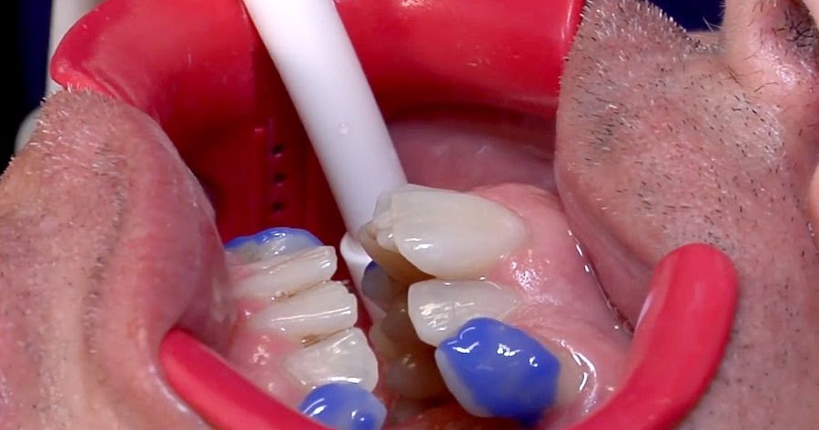 ORTHODONTICS: Invisalign step by step (Video 1) - Odonto-Tv