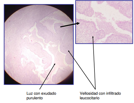 Patología B 2014 - tomás - 66072/0: SALPINGITIS