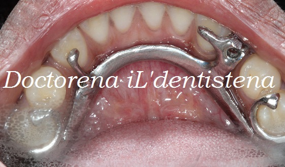 My Dental Diary: CO-Cr. RPD