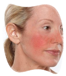 EsencialMente Tú: Tus mejillas coloradas y Dña. Rosácea