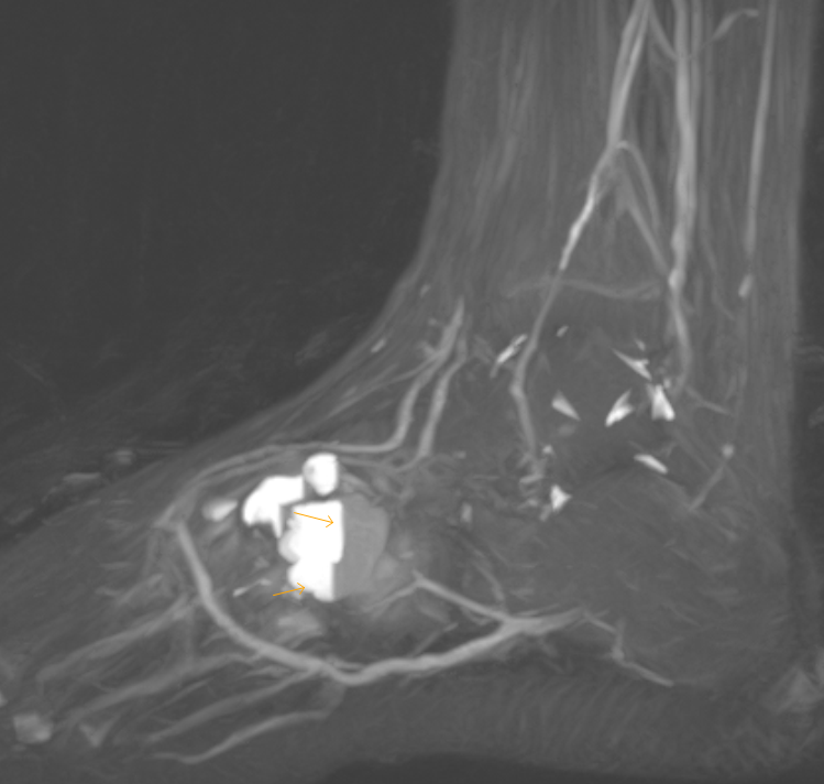 Aneurysmal Bone Cyst-Medial Cueniform-MRI - Sumer's Radiology Blog
