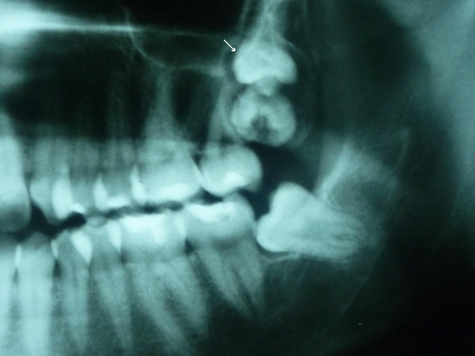 DENTAL INFORME: CUARTA MOLAR