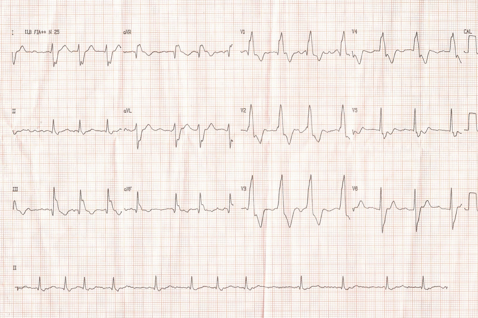 Blog de Eletrocardiografia: QUAL O DIAGNÓSTICO 23?