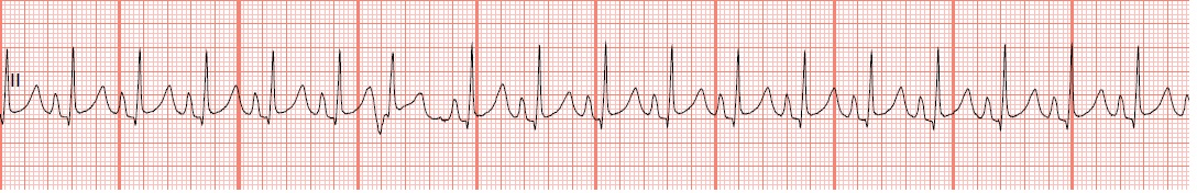 ECG Rhythm Strip Quiz 77