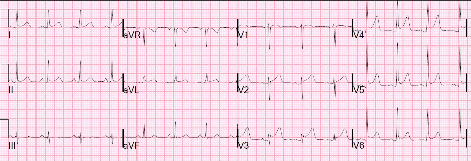 Dr. Smith's ECG Blog: 2011