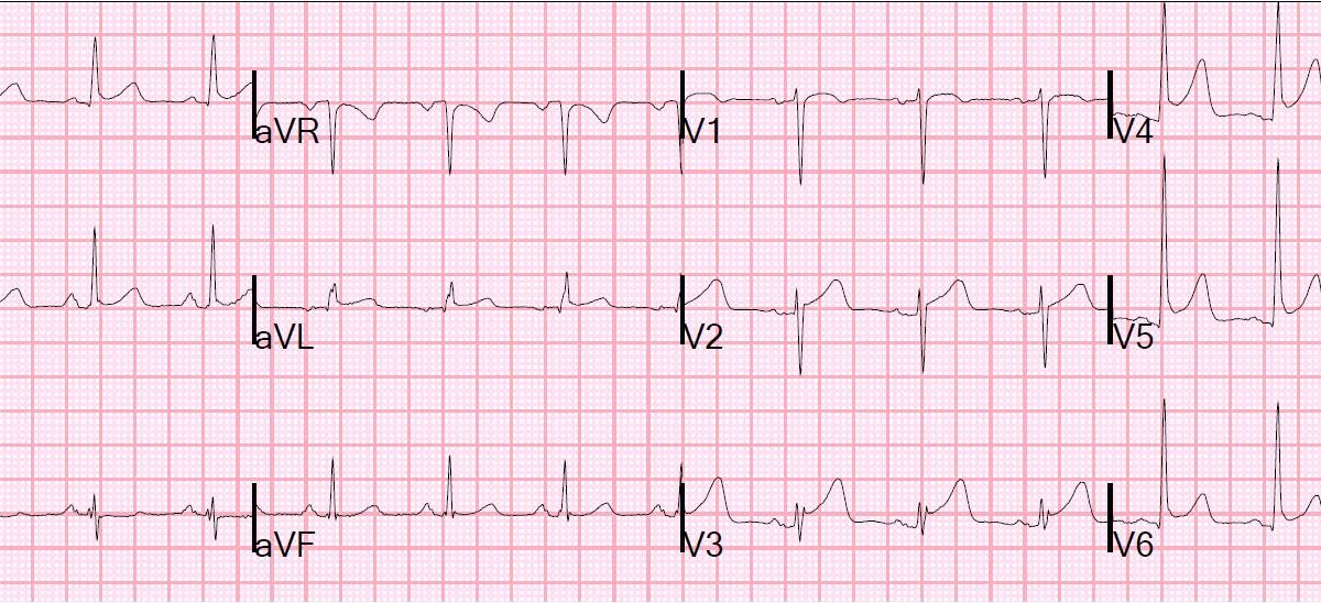 Dr. Smith's ECG Blog: Several Cases of ST Elevation from Early ...