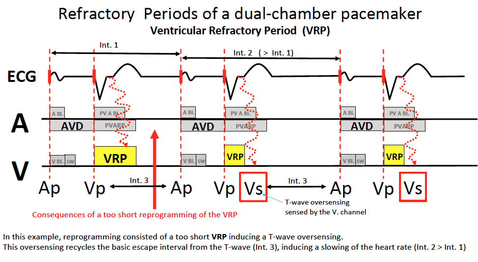 Dr Han Naung @ Henry Han : Electrophysiology and Heart Rhythm : AV ...