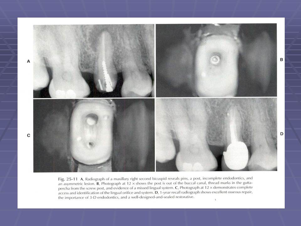 Dentistry: Endodontics, Armamentarium and techniques