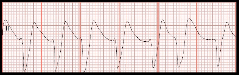 Practice EKG Rhythm Strips 143: Various Hyperkalemia