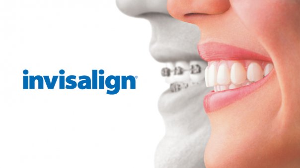 Dentista de modelos: Invisalign - Aparelho invisível