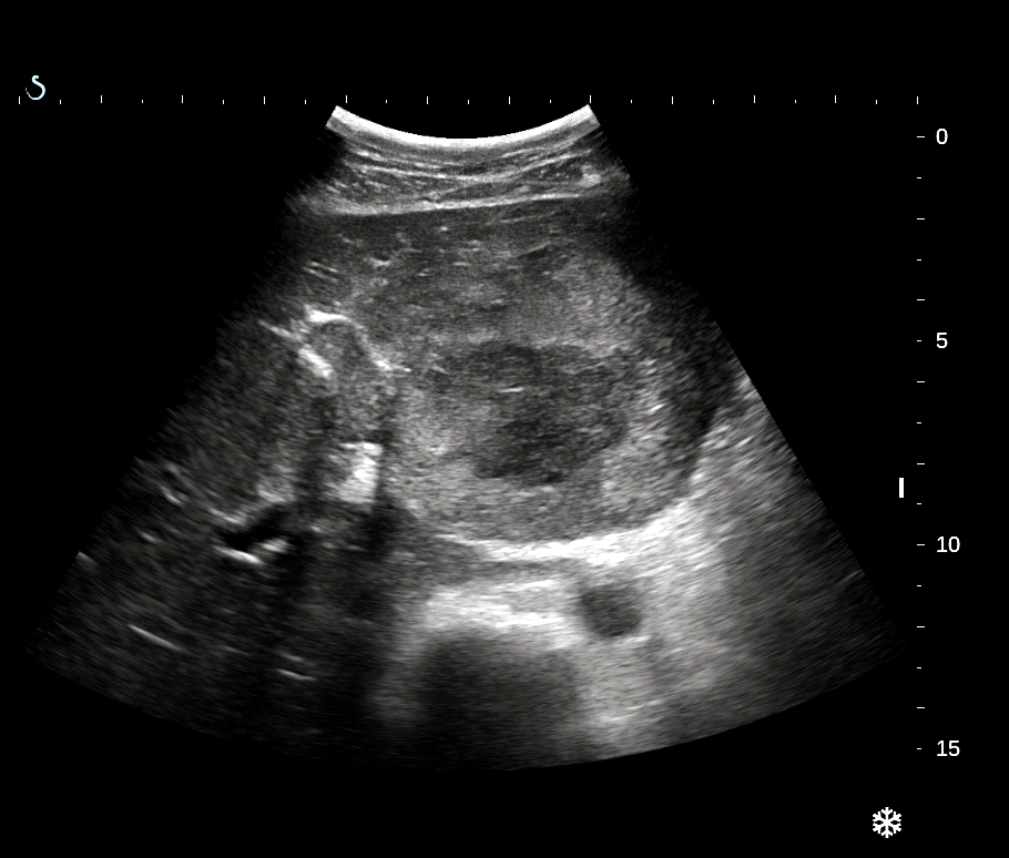 VIETNAMESE MEDIC ULTRASOUND: CASE 407: LIVER INFARCTION, Dr PHAN THANH ...