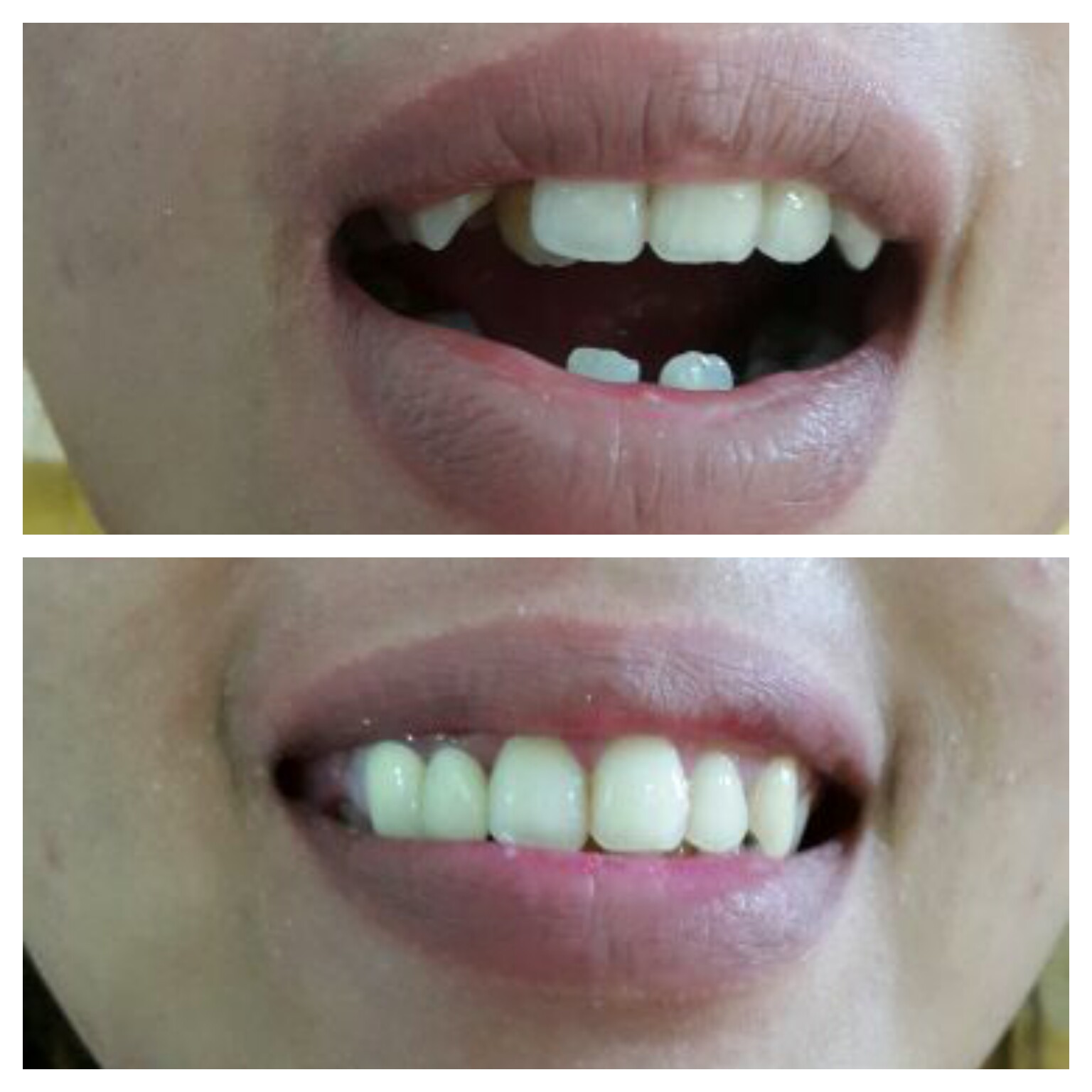 DOKTER GIGI BALI: Veneer Gigi | Samsung Gigi