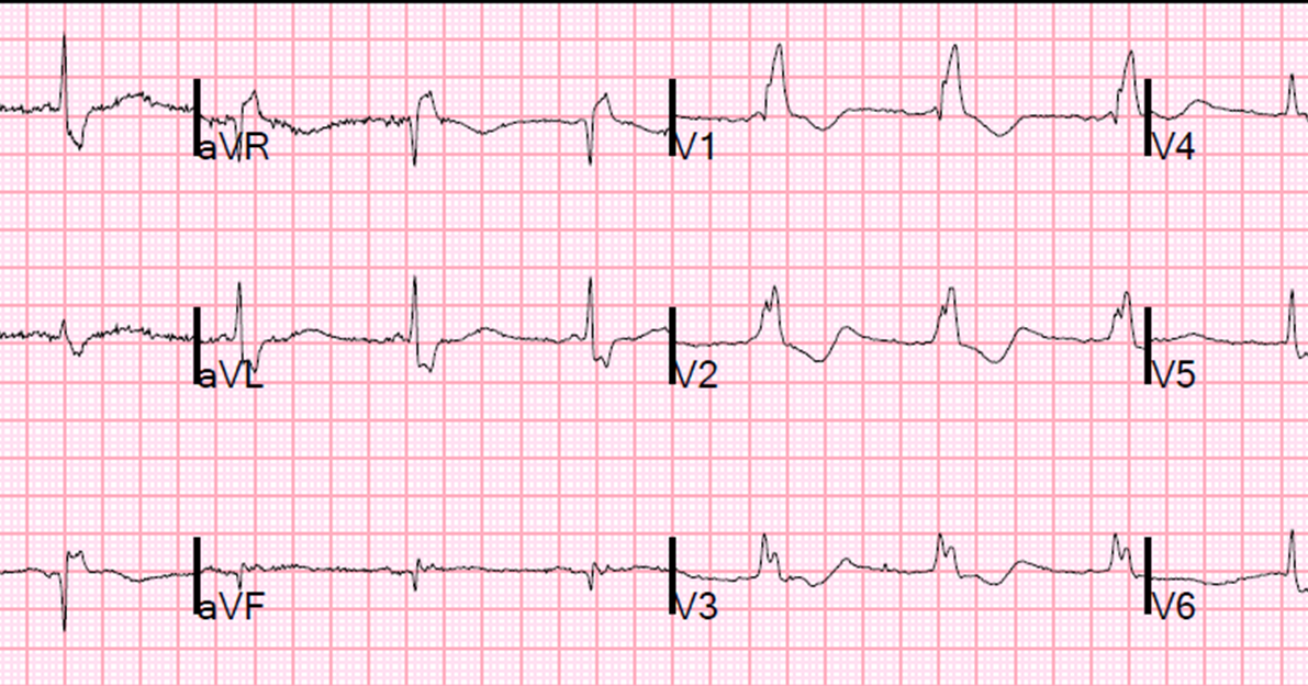 Dr. Smith's ECG Blog: PseudoSTEMI and True ST elevation in Right Bundle ...