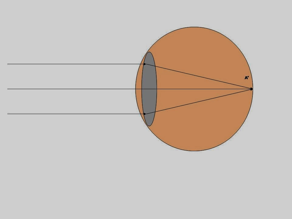 Belajar Fisika Yuuk!: Kondisi Mata