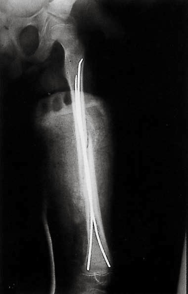 Fracturas asociadas a enfermedadneurológica