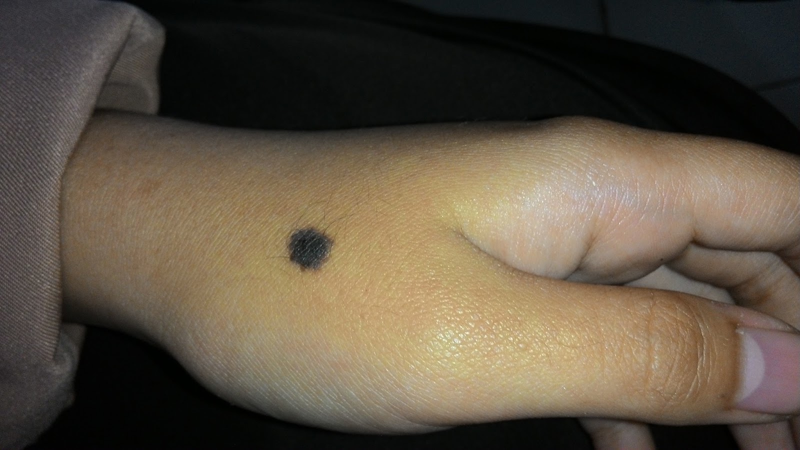 16 Cara Menghilangkan Tompel (Tanda Lahir) Dengan Cepat dan Ampuh ...