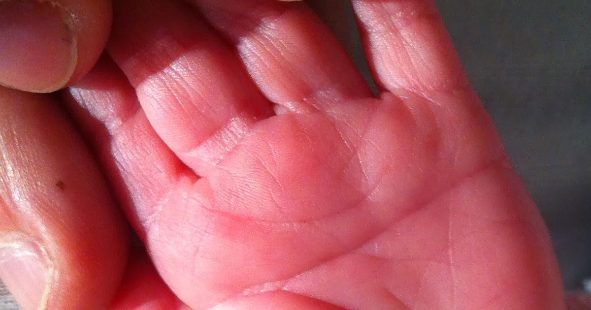 LINEA SIMIESCA O PLIEGUE PALMAR, VENTAJAS E INCONVENIENTES - El futuro ...