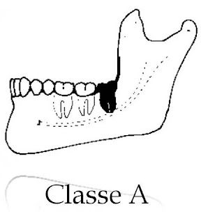 Muito bom esse café !: Classificação de Pell e Gregory - Cirurgia Oral