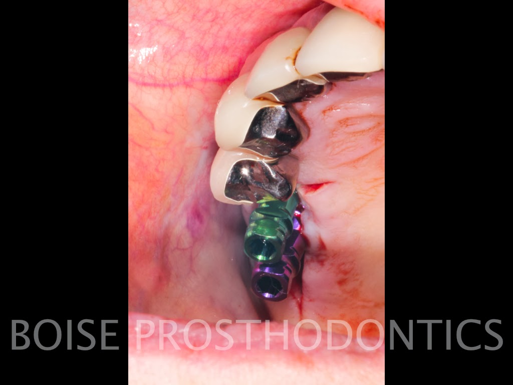 Boise Idaho Prosthodontics: Posterior Provisional Zimmer Implant ...