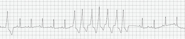 Practice ECG Rhythm Strips 94