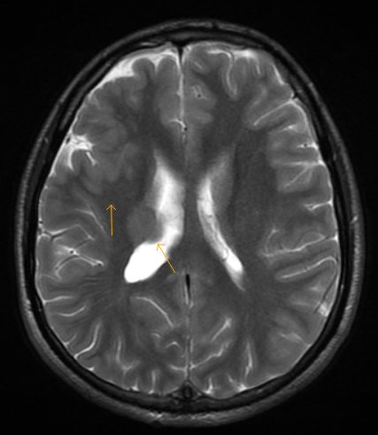 Grey matter heterotopia-MRI - Sumer's Radiology Blog