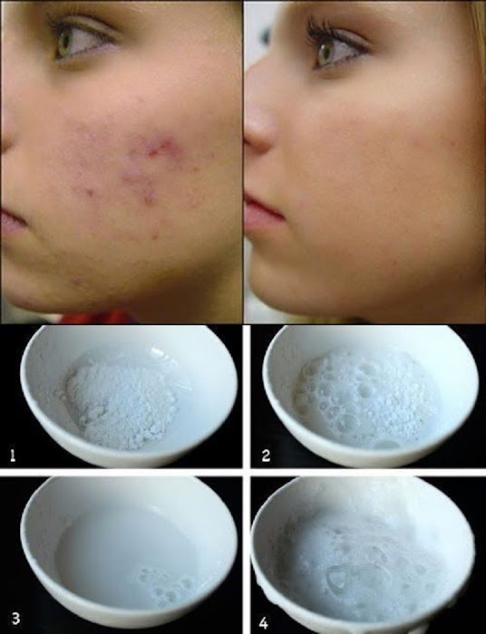 How to Get Rid Of Redness From Acne And Pimples