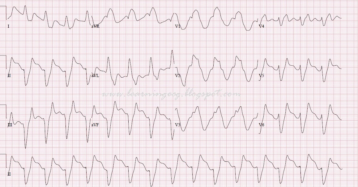 ECG Rhythms: Really Wide QRS Tachycardia