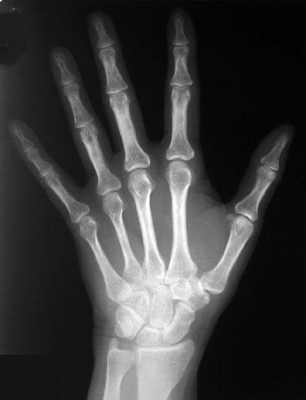 Tecnicas Radiológicas 2011: Mano Proyección PA