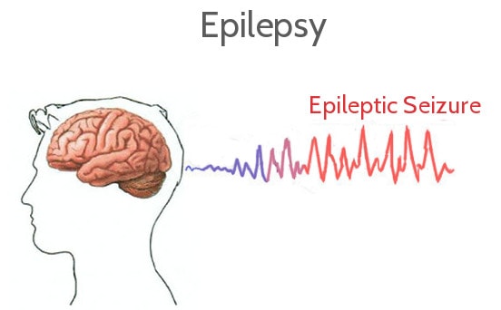 What is Epilepsy: Its Causes and Treatment | GREAT TOPS