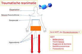 E-Learning: Traumatische reanimatie is HOTT// - Acute Zorg Blog