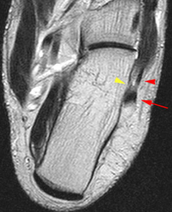 MRI Musculo-Skeletal Section: Normal anatomy of peroneus tendon on MRI
