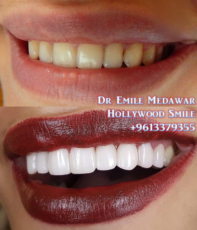 Hollywood Smile Lebanon, Beirut Dentist Dr Emile Medawar: Great ...