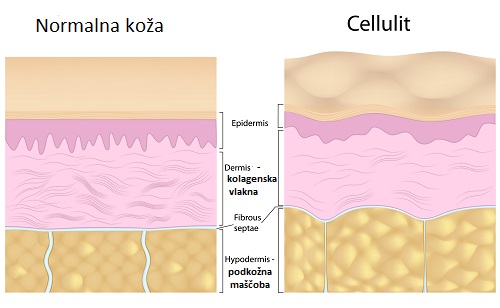 Celulit, bolest slabog metabolizma i nepravilne ishrane - InfoNet Magazin