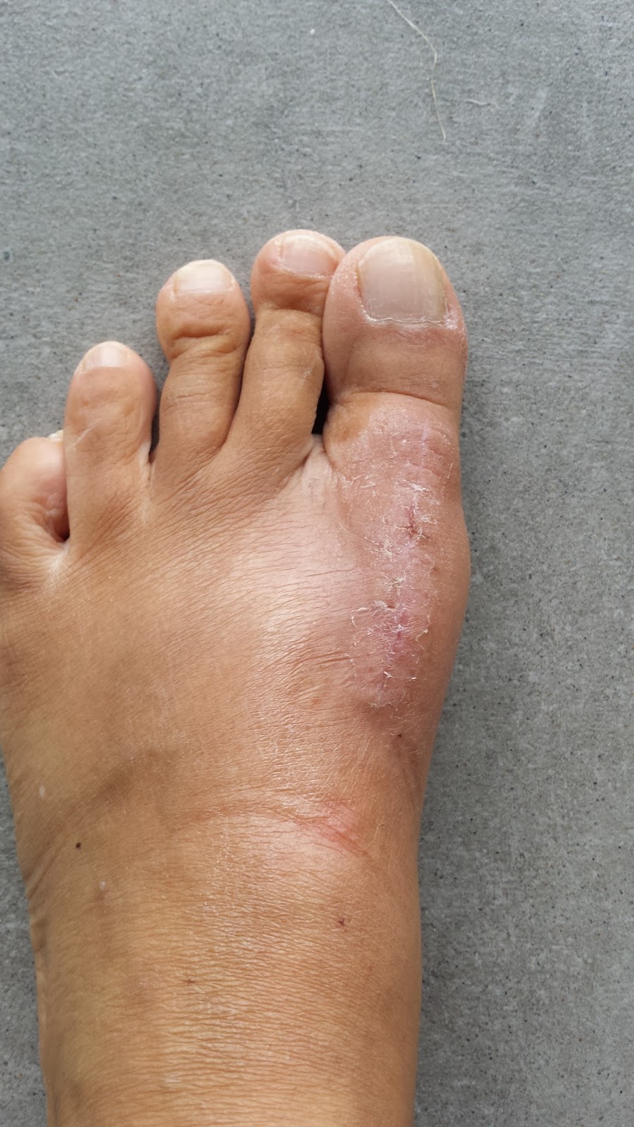 My Cheilectomy Journal: September 2015