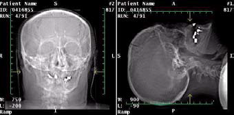 Computed Tomography: Conventional vs CT-SIM
